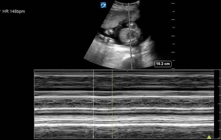 M-Mode (Yes) vs Doppler (No) | ALARA | Fetal Heart Rate — Everyday ...