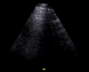 D Sign | Pulmonary Embolism | I Farooqui & J Bloom | Bronx, NY ...