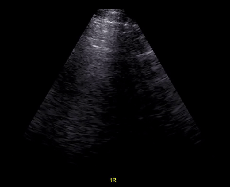 D Sign | Pulmonary Embolism | I Farooqui & J Bloom | Bronx, NY ...