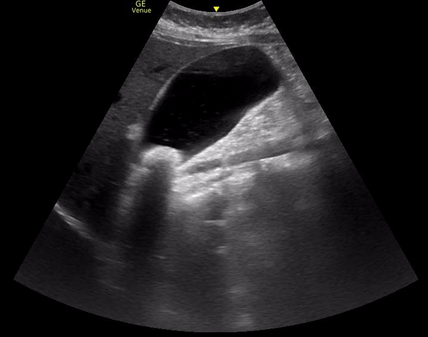 Stone In Neck [SIN] Phenomenon | Acute Cholecystitis | J Esteban Munoz ...