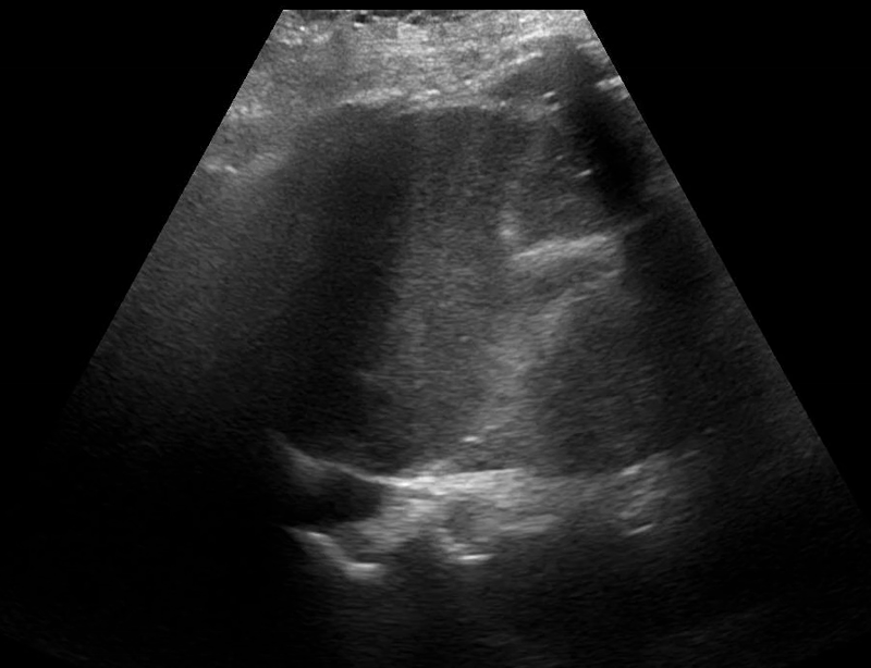 Pleural Effusion | 'Spine Sign' | T Pistell, S Patel, W Murk, & M ...
