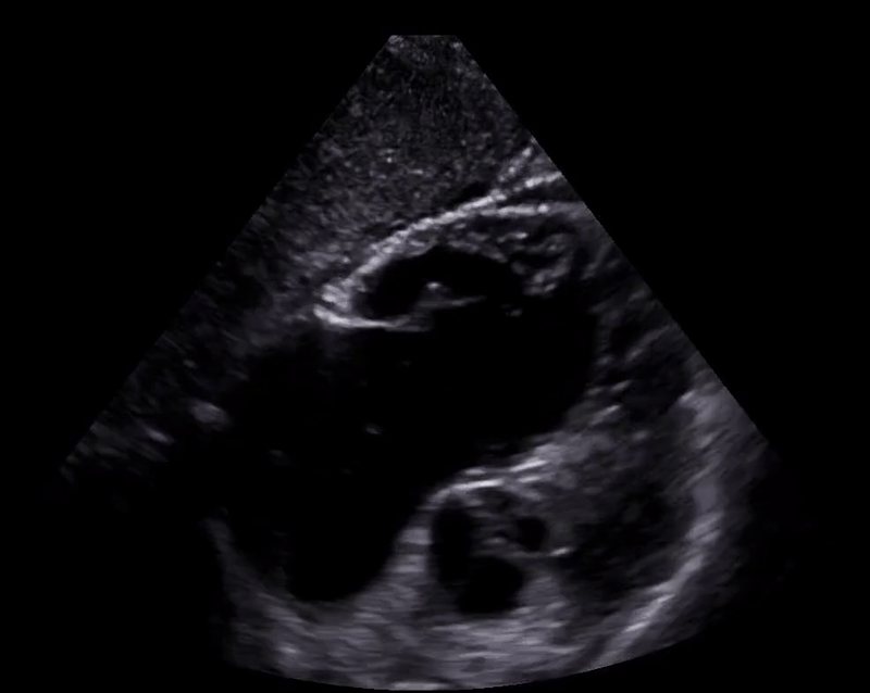D Sign | Pulmonary Embolism | I Farooqui & J Bloom | Bronx, NY ...