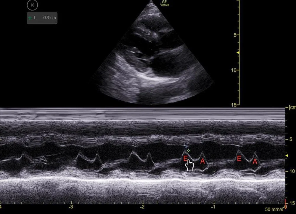 Normal EF | EPSS (Quantified) | M Halperin | Bronx NY — Everyday Ultrasound