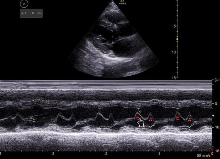 Normal EF | EPSS (Quantified) | M Halperin | Bronx NY — Everyday Ultrasound