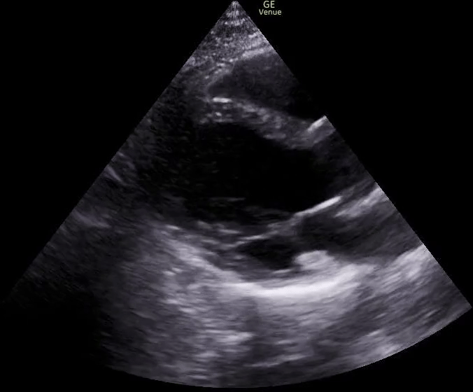 Normal EF | EPSS (Quantified) | M Halperin | Bronx NY — Everyday Ultrasound