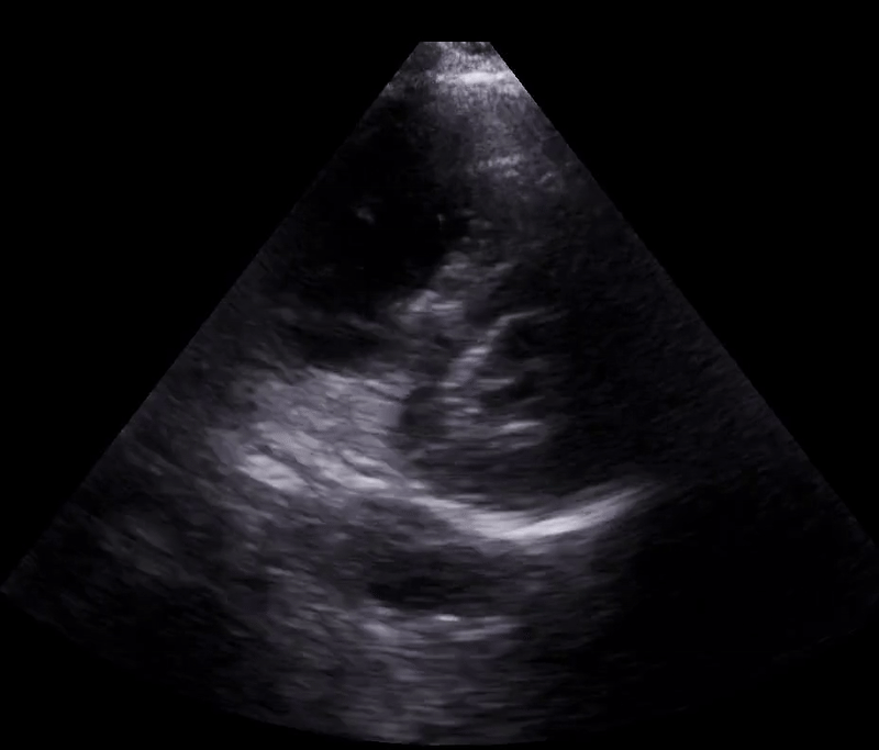 D Sign | Pulmonary Embolism | I Farooqui & J Bloom | Bronx, NY ...