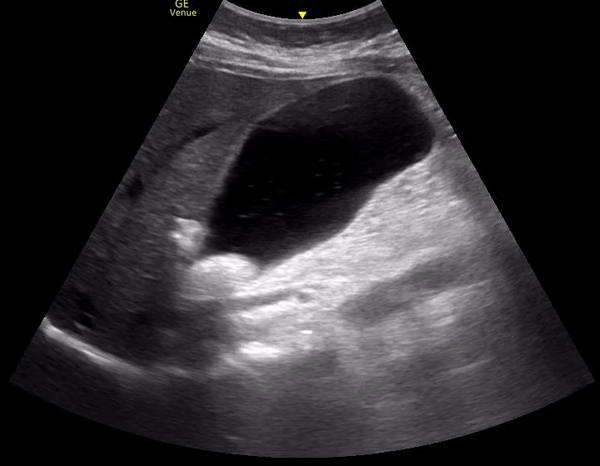 Stone In Neck [SIN] Phenomenon | Acute Cholecystitis | J Esteban Munoz ...