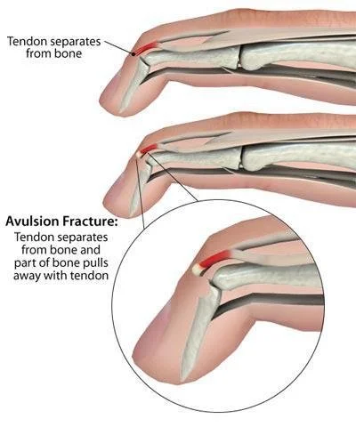 Blog | Set in Motion Physiotherapy