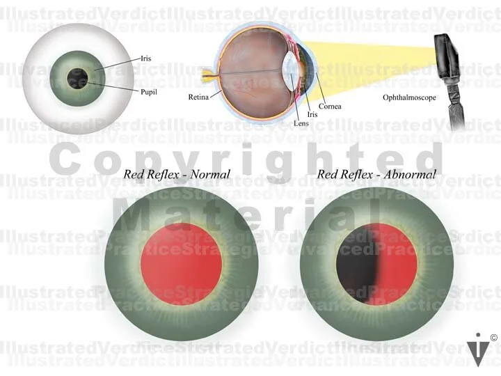 Stock Eye: Cataract / Intraocular Lens (IOL) — Illustrated Verdict
