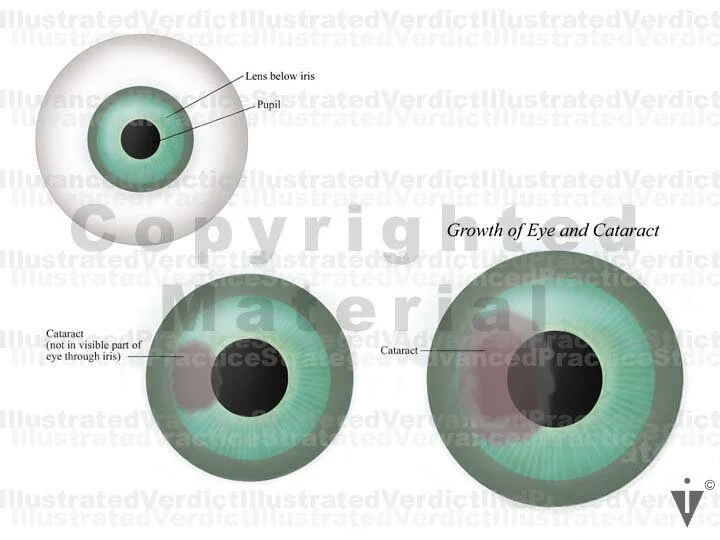 Stock Eye: Cataract / Intraocular Lens (IOL) — Illustrated Verdict
