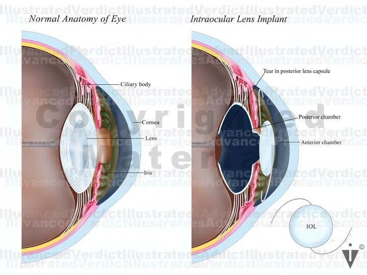 Stock Eye: Cataract / Intraocular Lens (IOL) — Illustrated Verdict