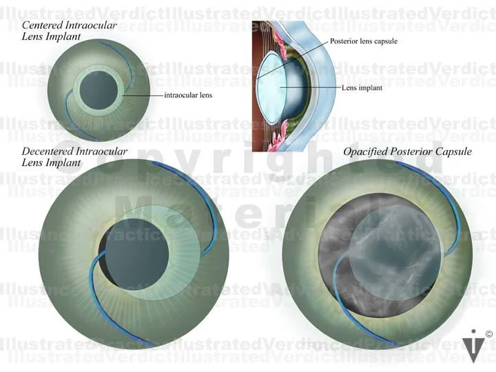 Stock Eye: Cataract / Intraocular Lens (IOL) — Illustrated Verdict