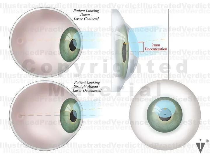 Stock Eye: Laser Surgery — Illustrated Verdict