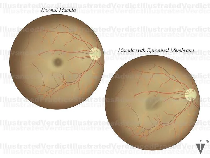 Stock Eye: Retinal Injuries and Anomalies — Illustrated Verdict
