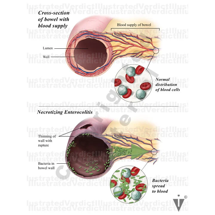 Stock Bowel: Infant NEC / Resection / Short Bowel Syndrome ...