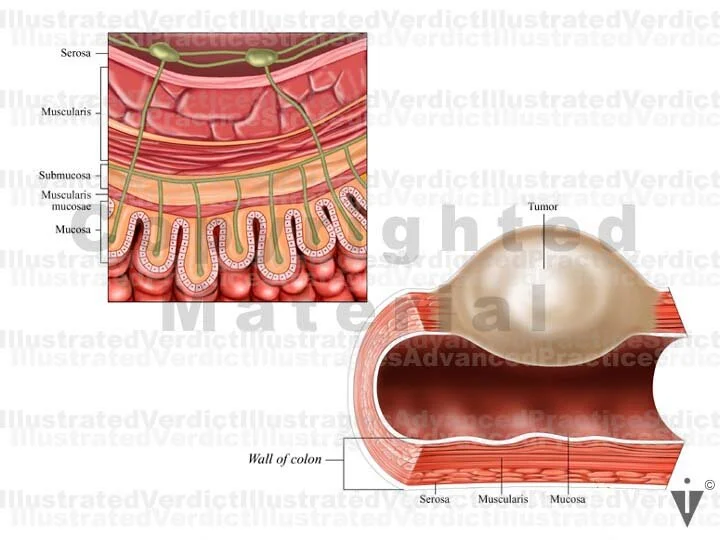 Stock Colon: Cancer / Masses — Illustrated Verdict