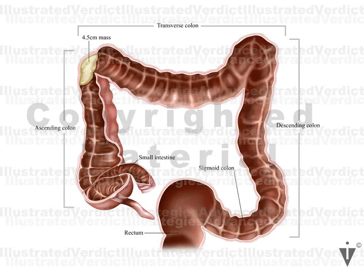 Stock Colon: Cancer / Masses — Illustrated Verdict