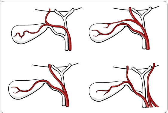 Stock Gallbladder: Variations (ducts, arteries, stones, tumors ...
