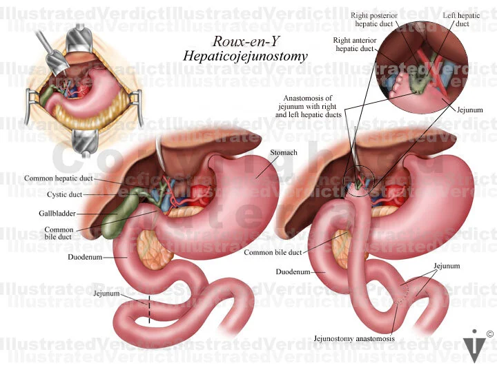 Stock Gallbladder: Hepaticojejunostomy — Illustrated Verdict