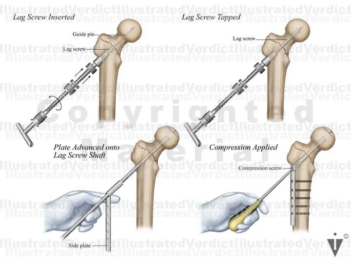 Stock Elder Care - Orthopedic: Hip Surgery — Illustrated Verdict