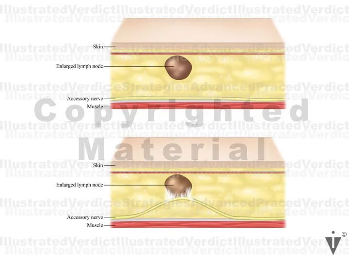 Stock Neck: Lymph Node Masses — Illustrated Verdict