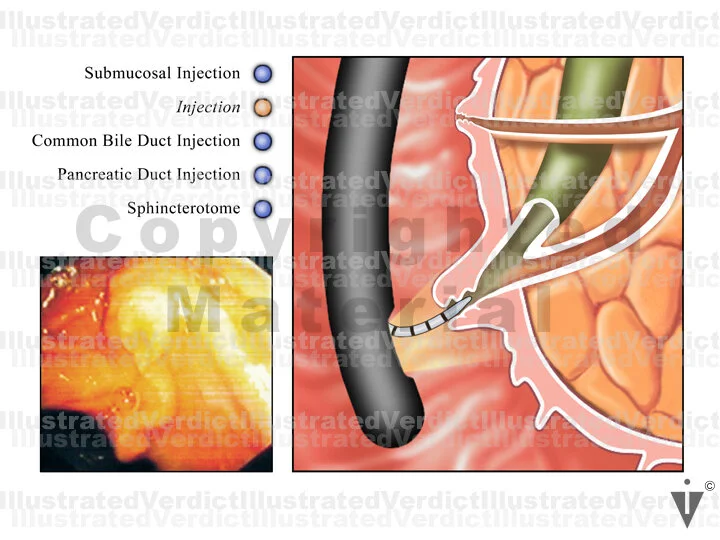 Stock Gallbladder / Pancreas: ERCP — Illustrated Verdict