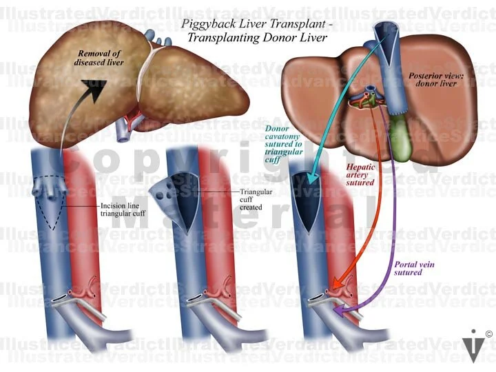 Stock Liver: Surgeries / Transplants — Illustrated Verdict