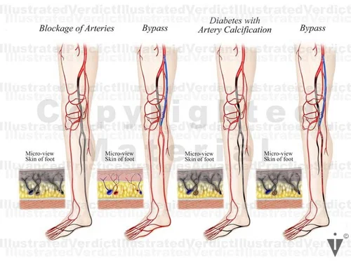 Stock Lower Limb: Bypass of Vasculature — Illustrated Verdict