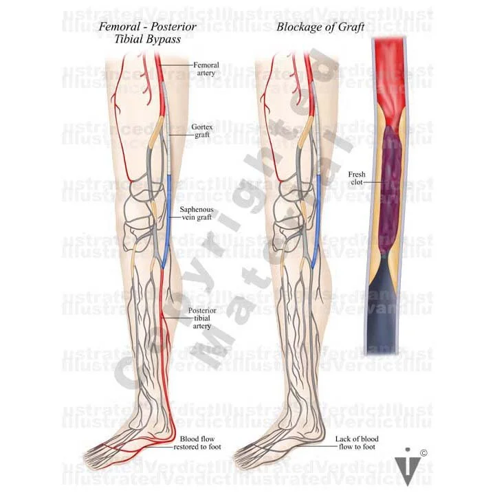 Stock Lower Limb: Bypass of Vasculature — Illustrated Verdict