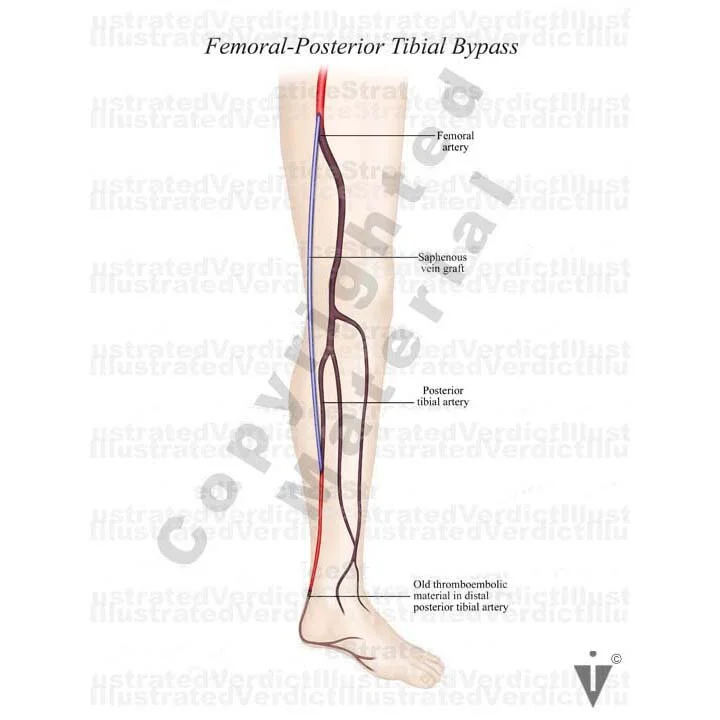 Stock Lower Limb: Bypass of Vasculature — Illustrated Verdict