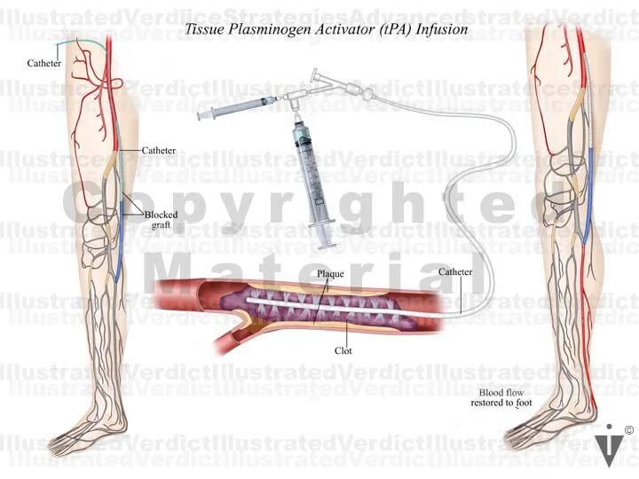 Stock Lower Limb: Bypass of Vasculature — Illustrated Verdict