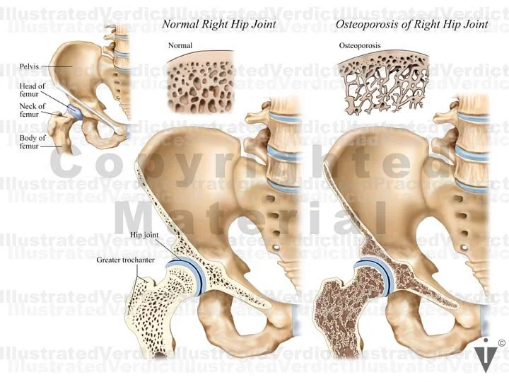 Template Hip: Arthritis / Defects / Injury / Necrosis — Illustrated Verdict