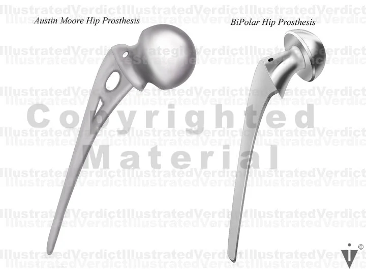 Stock Hip: Replacement — Illustrated Verdict
