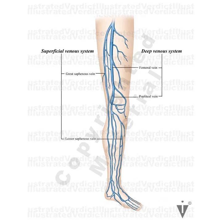 Stock Lungs: Pulmonary Embolism — Illustrated Verdict