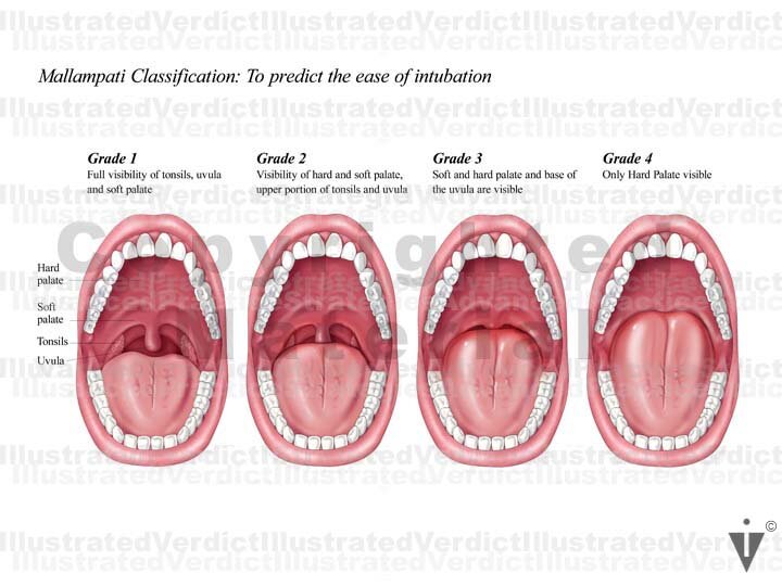 Stock Throat: Intubation / Tracheostomy — Illustrated Verdict