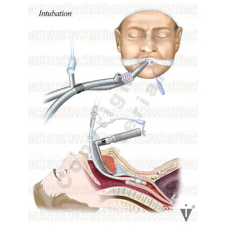 Stock Throat: Intubation / Tracheostomy — Illustrated Verdict
