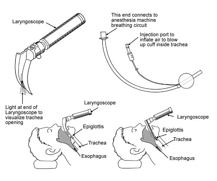 Stock Throat: Intubation / Tracheostomy — Illustrated Verdict