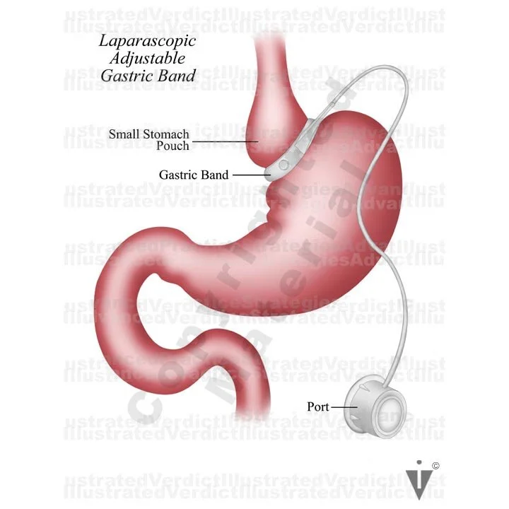 Stock Bariatric: Lap-Band Procedure — Illustrated Verdict