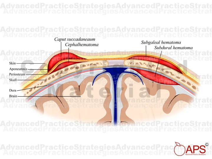 Stock Baby: Brain Bleeds / Hemorrhages — Illustrated Verdict