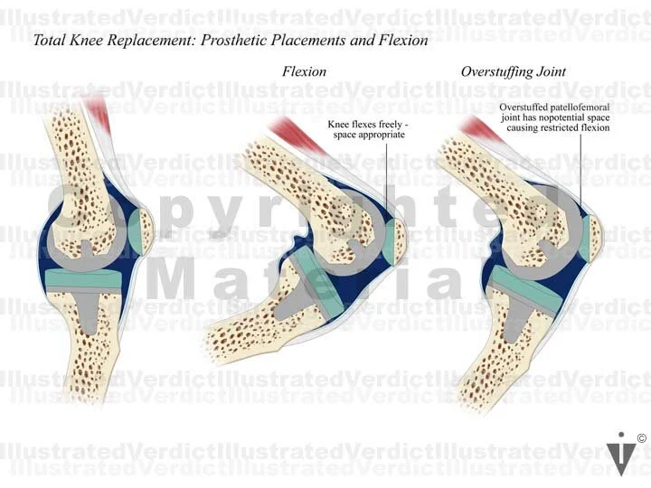 Stock Knee: Replacement — Illustrated Verdict