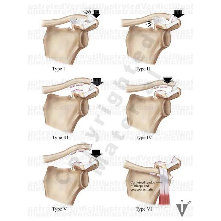 Stock Shoulder: Injuries — Illustrated Verdict