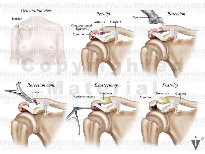 Stock Shoulder: Surgeries — Illustrated Verdict