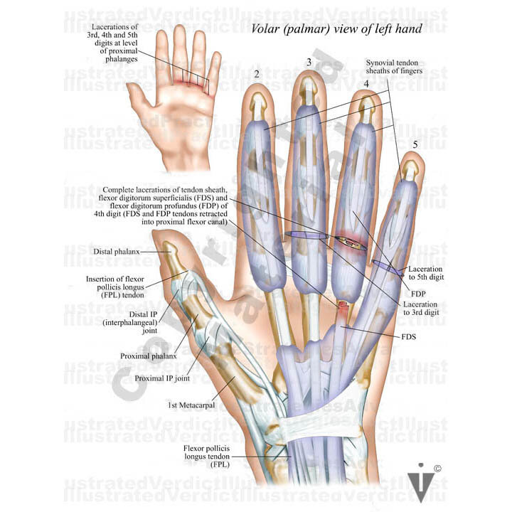 Stock Upper Limb: Hand — Illustrated Verdict