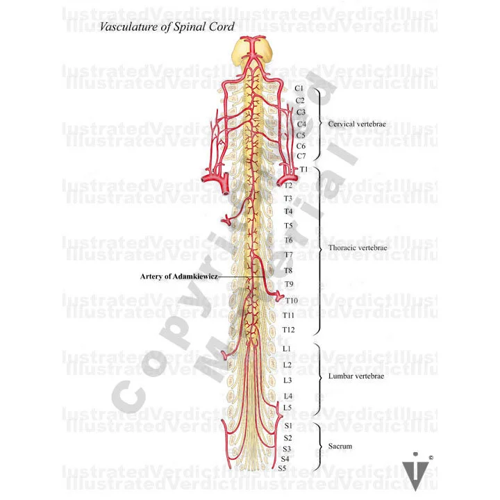 Template Spine: Spine Cord Stimulator — Illustrated Verdict