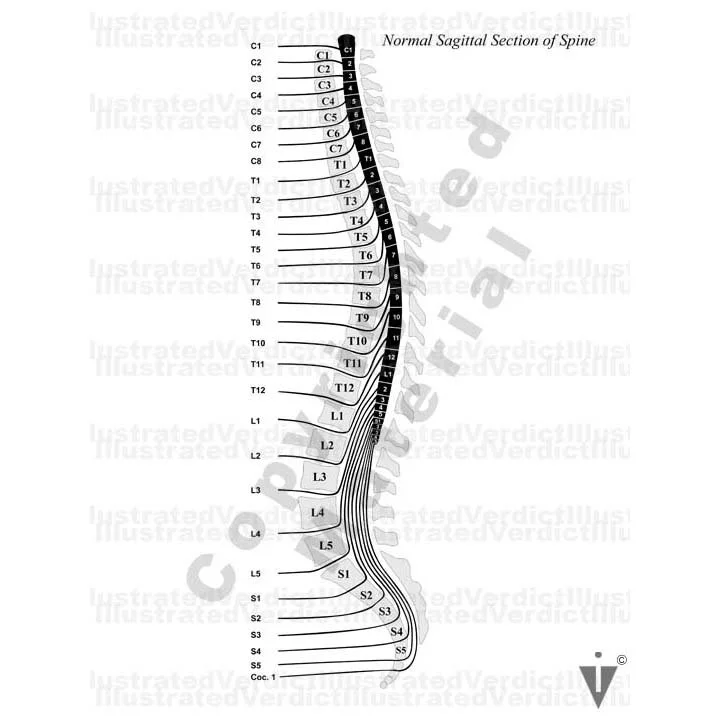Template Spine: Spine Cord Stimulator — Illustrated Verdict