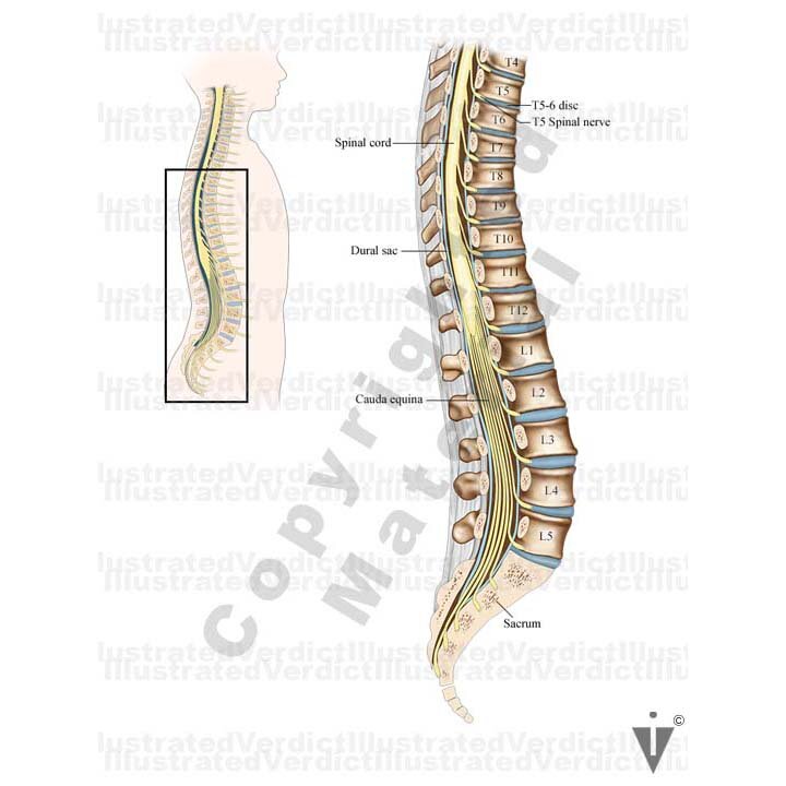 Template Spine: Spine Cord Stimulator — Illustrated Verdict