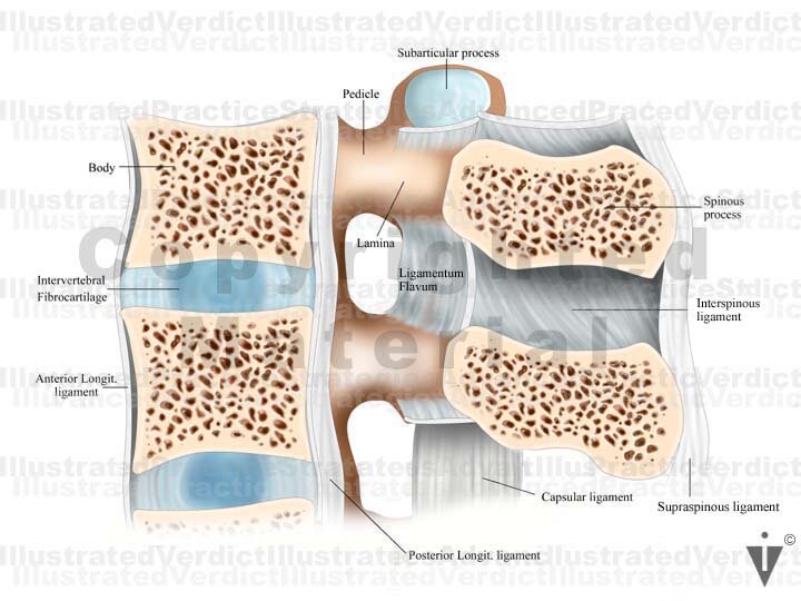 Template Spine: Spine Cord Stimulator — Illustrated Verdict
