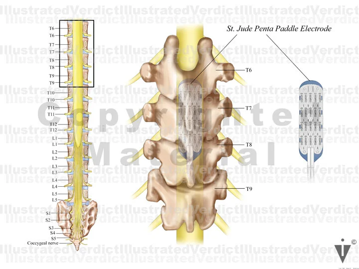 Template Spine: Spine Cord Stimulator — Illustrated Verdict