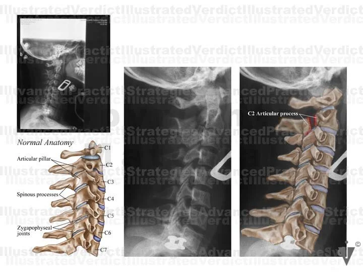 Stock Spine: Cervical Spine — Illustrated Verdict