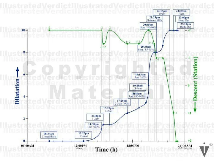 Stock Pregnancy / Delivery: Charts / Graphs / Labor Curves ...